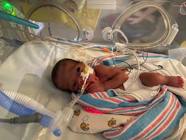 James’ success story after life-saving PDA surgery to close a ...