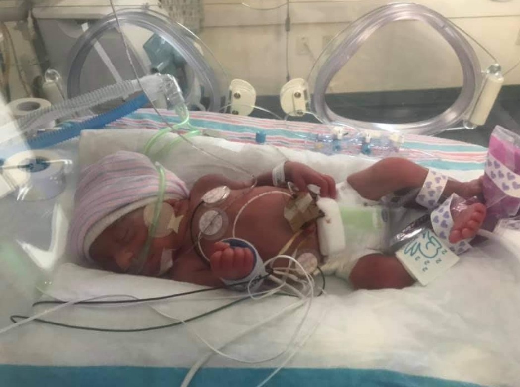 baby spends months in the NICU and PICU