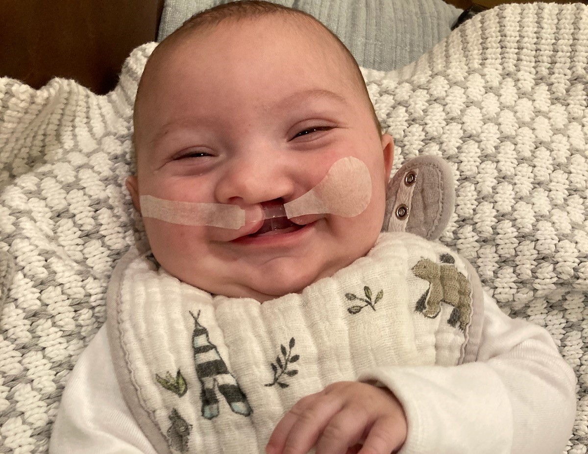 Three surgeries by age one: Jude Trigo's journey with a cleft lip and ...